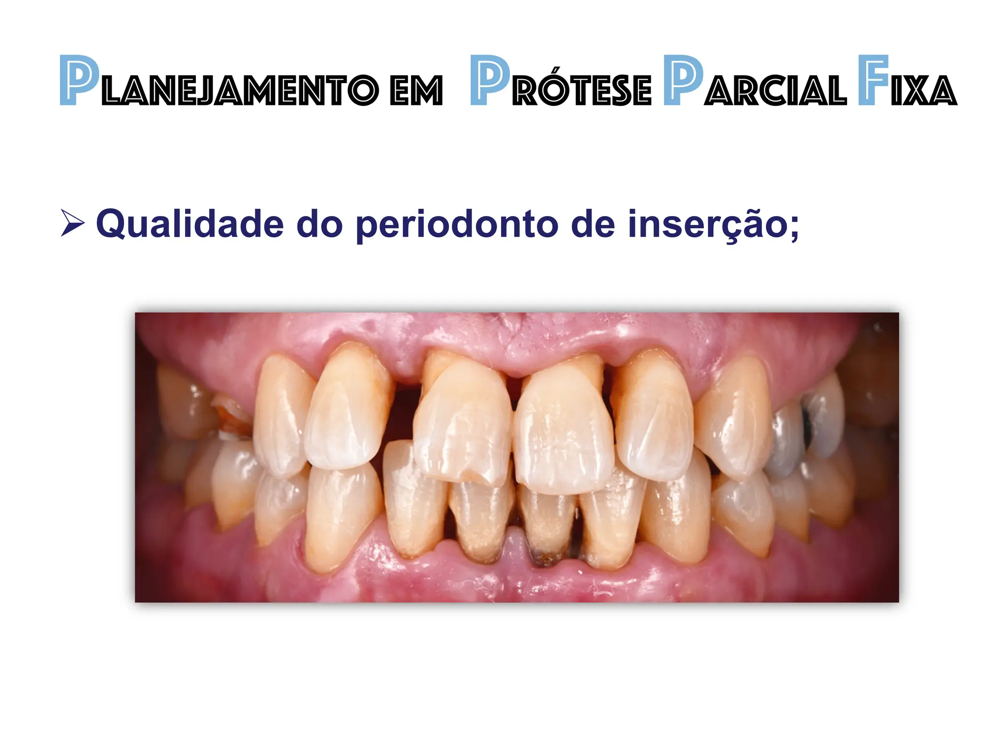 Aula prótese parcial fixa disciplina PPF | PDF