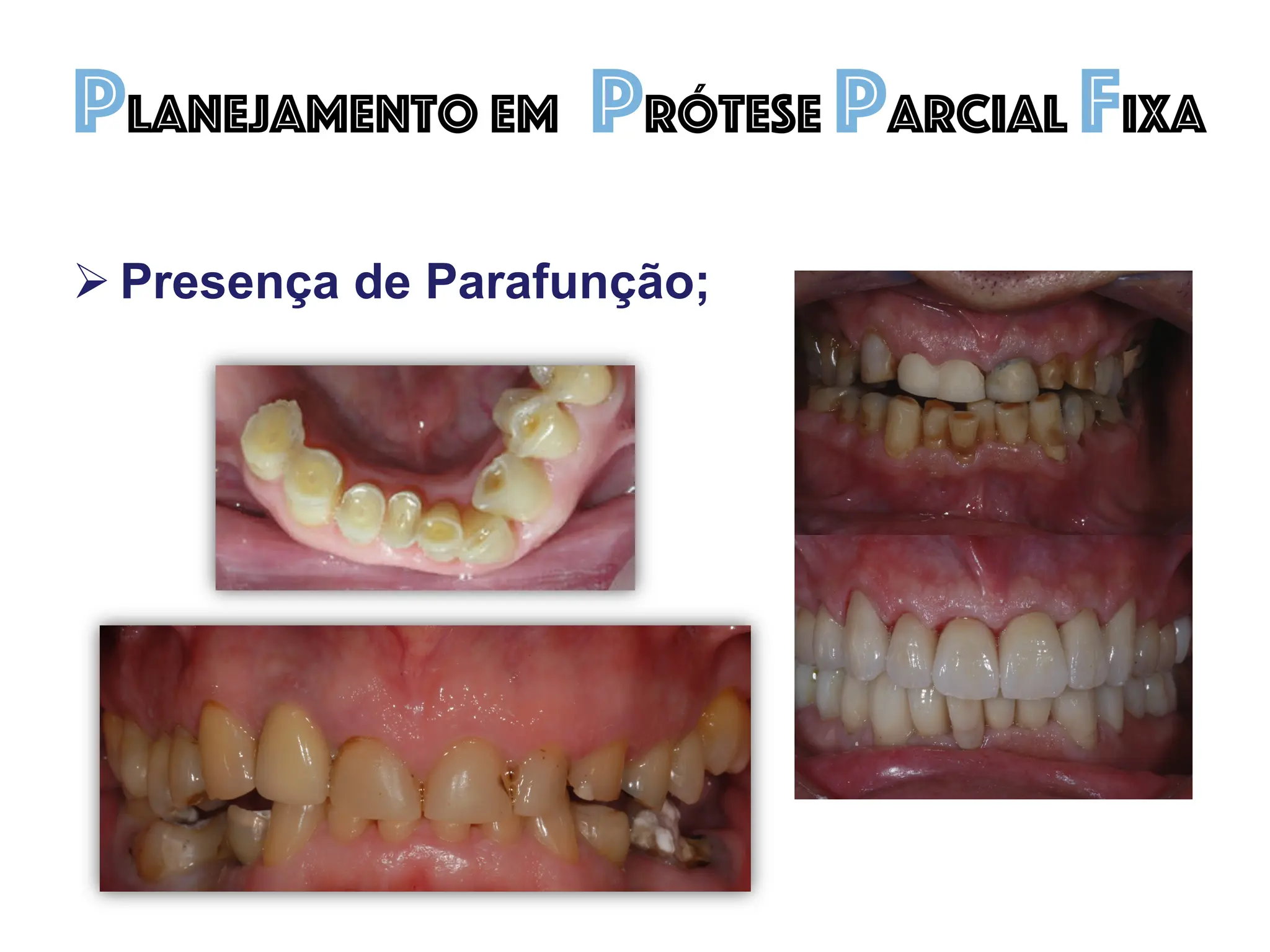 Aula prótese parcial fixa disciplina PPF | PDF