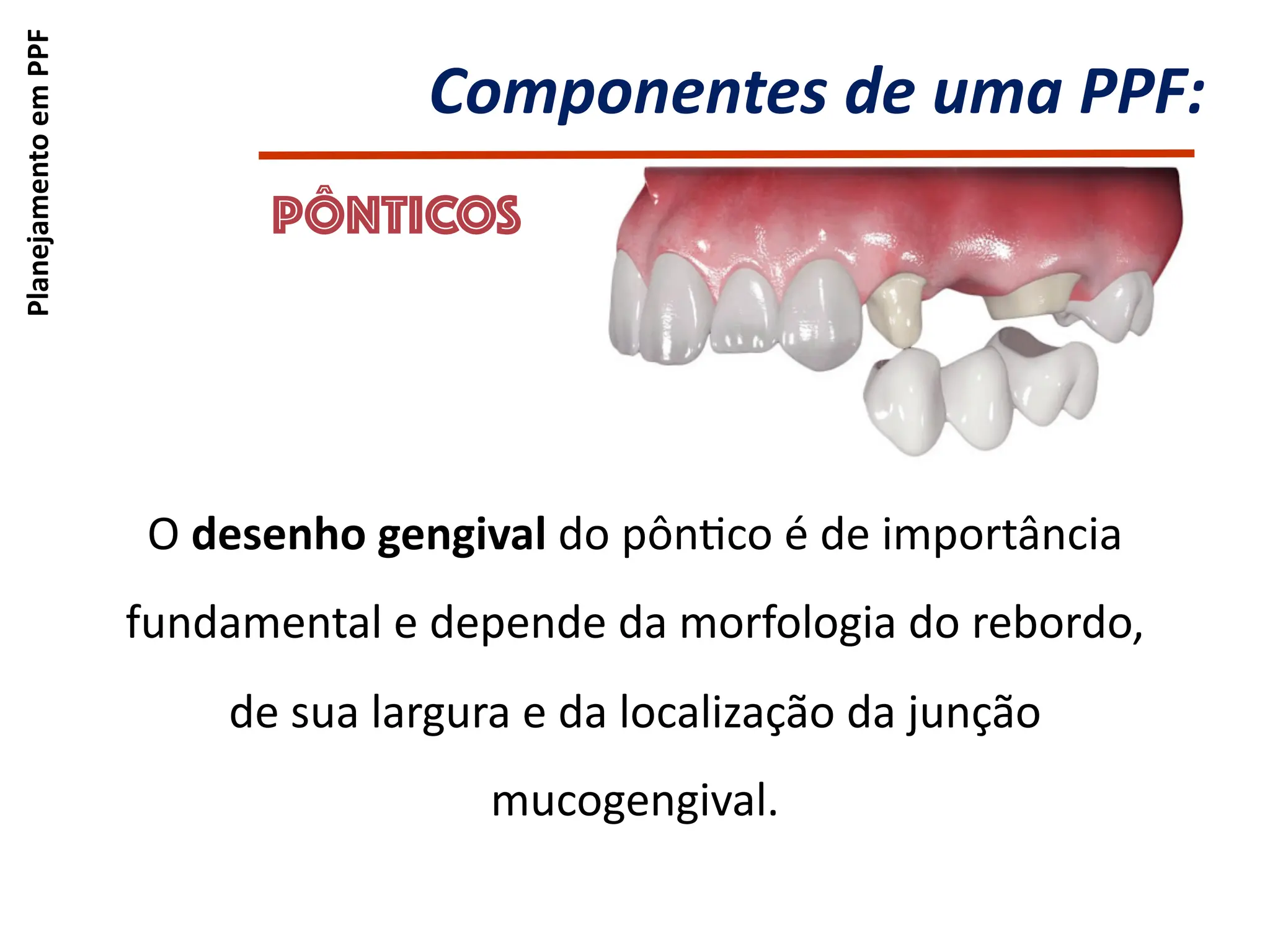 Aula prótese parcial fixa disciplina PPF | PDF