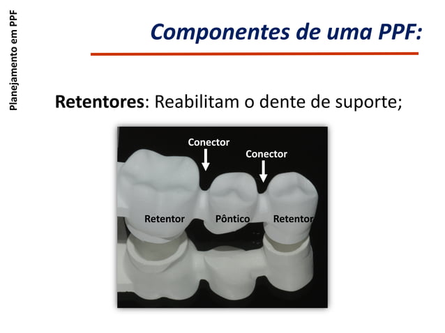 Aula prótese parcial fixa disciplina PPF | PDF