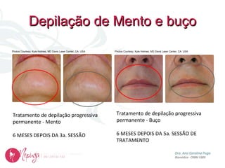 Curso de Depilação a Laser de Diodo, LIP e NdYag | PPT