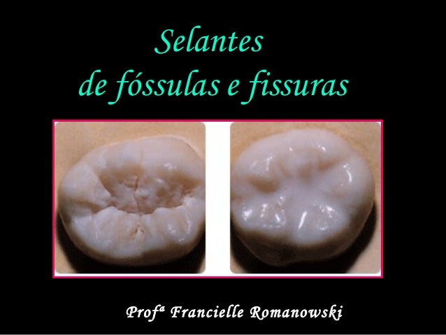 Selantes odontopediatria