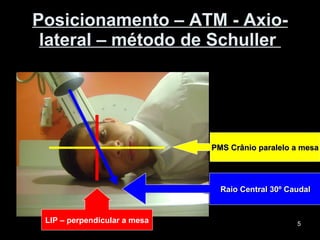 Aula sobre ATM e Mandíbula - raios X