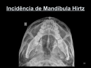 Aula sobre ATM e Mandíbula - raios X