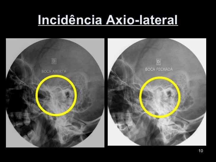 Aula sobre ATM e Mandíbula - raios X