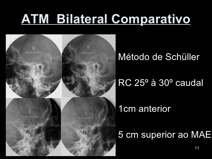 Aula sobre ATM e Mandíbula - raios X