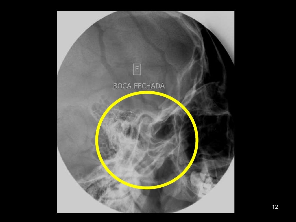 Aula sobre ATM e Mandíbula - raios X