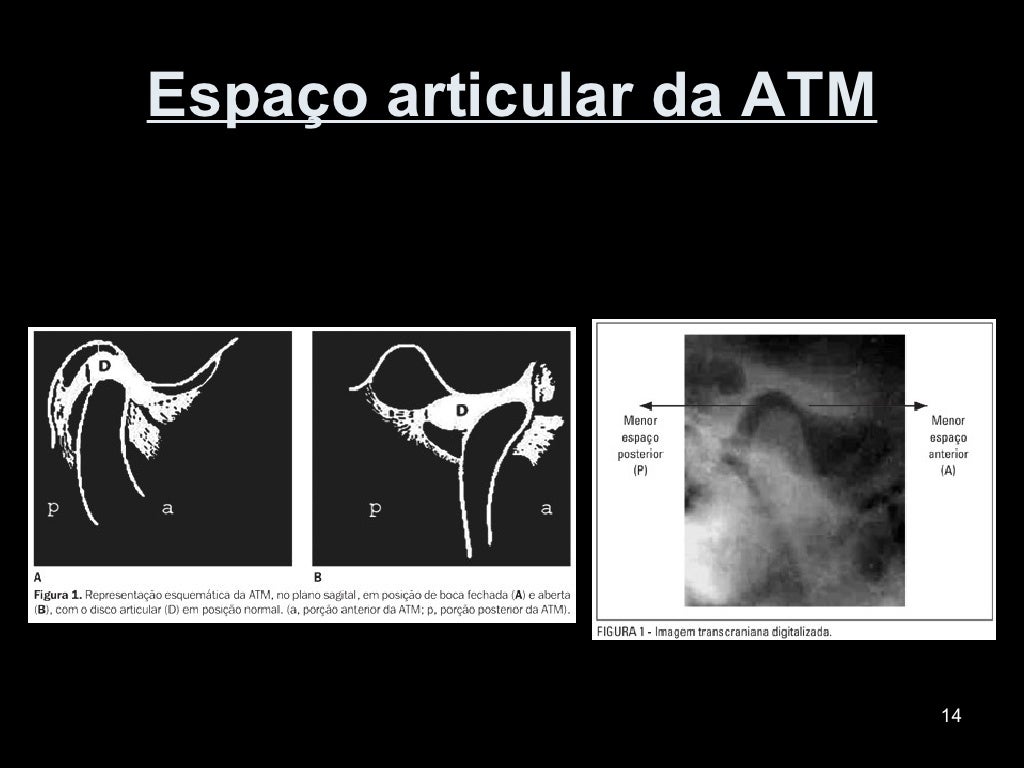 Aula sobre ATM e Mandíbula - raios X