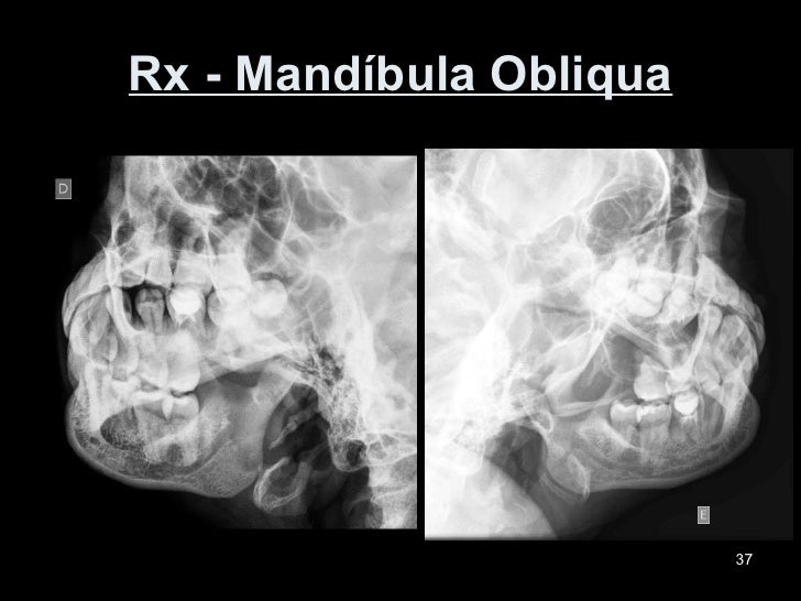 Aula Sobre Atm E Mandíbula Raios X