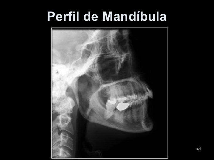Aula sobre ATM e Mandíbula - raios X
