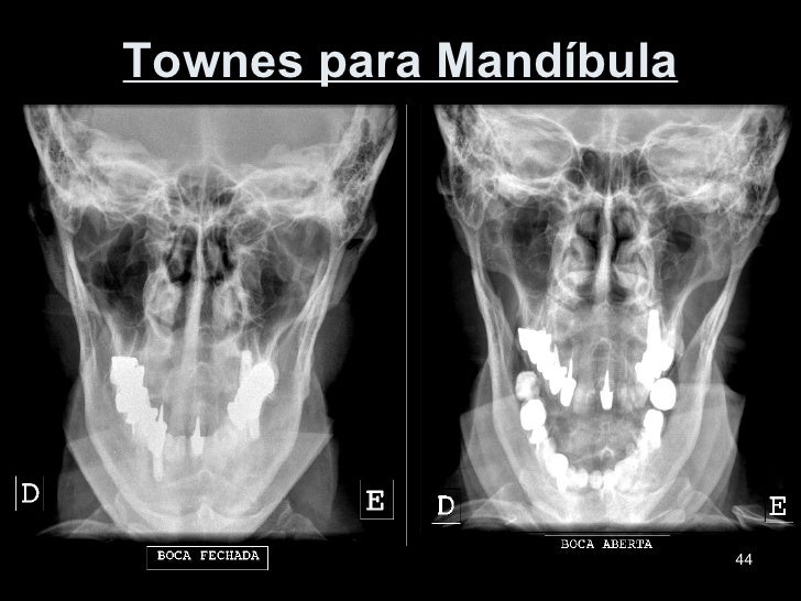 Aula sobre ATM e Mandíbula - raios X