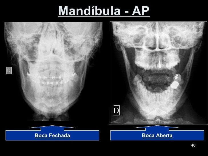 Aula sobre ATM e Mandíbula - raios X