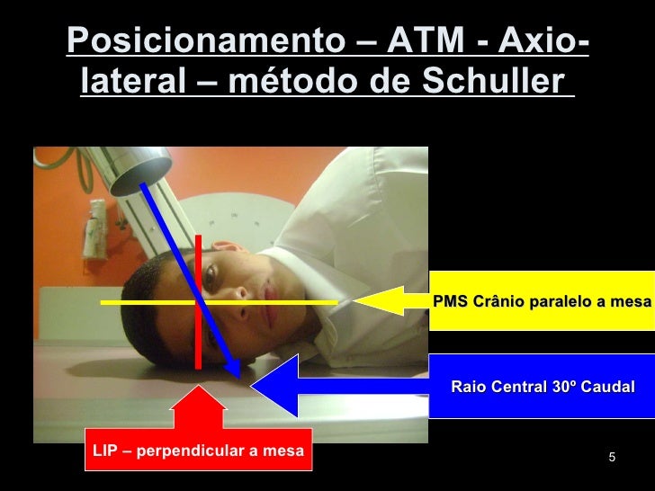 Aula sobre ATM e Mandíbula - raios X