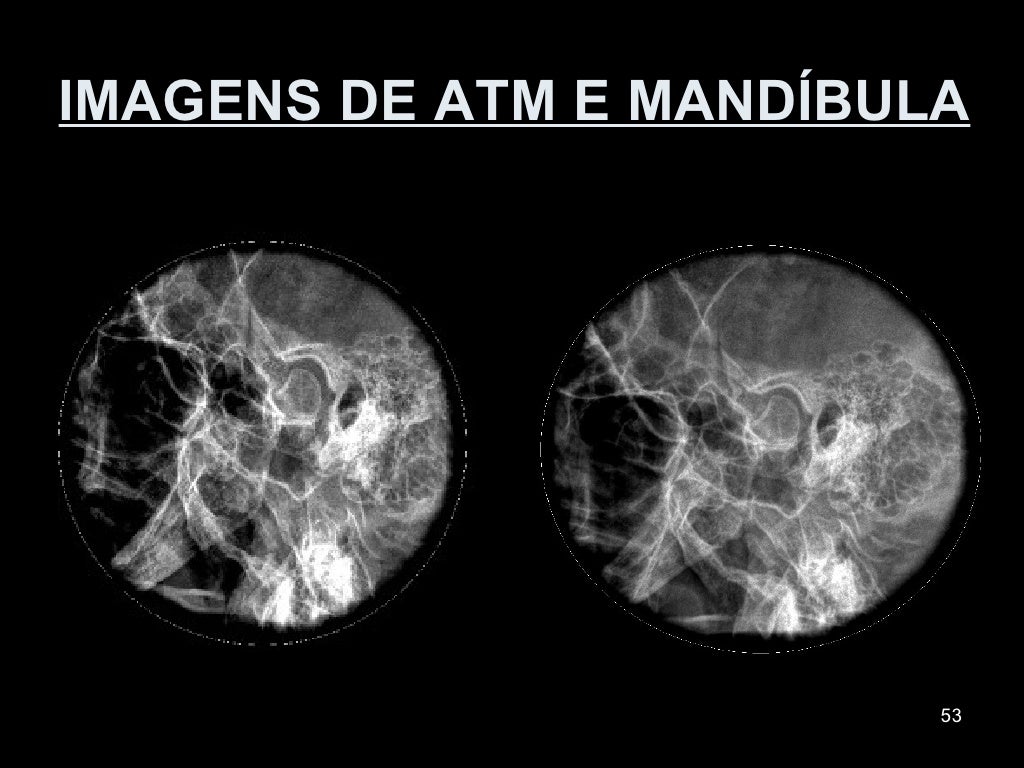 Aula sobre ATM e Mandíbula - raios X