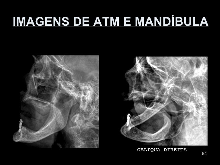 Aula sobre ATM e Mandíbula - raios X