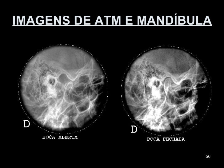 Aula sobre ATM e Mandíbula - raios X
