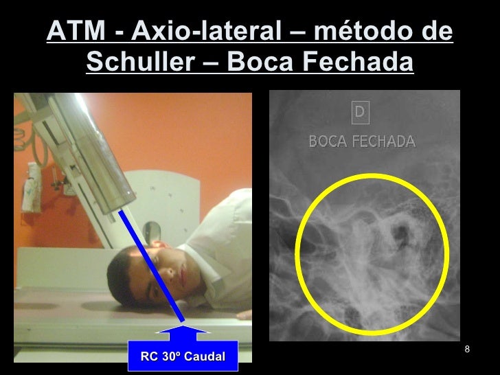 Aula sobre ATM e Mandíbula - raios X