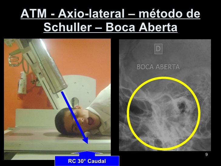 Aula sobre ATM e Mandíbula - raios X