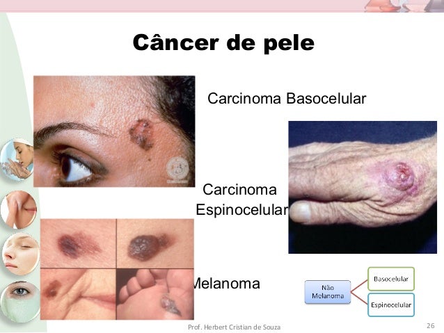 Carcinoma Espinocelular Fotos _ Carcinome spinocellulaire — Wikipédia ...