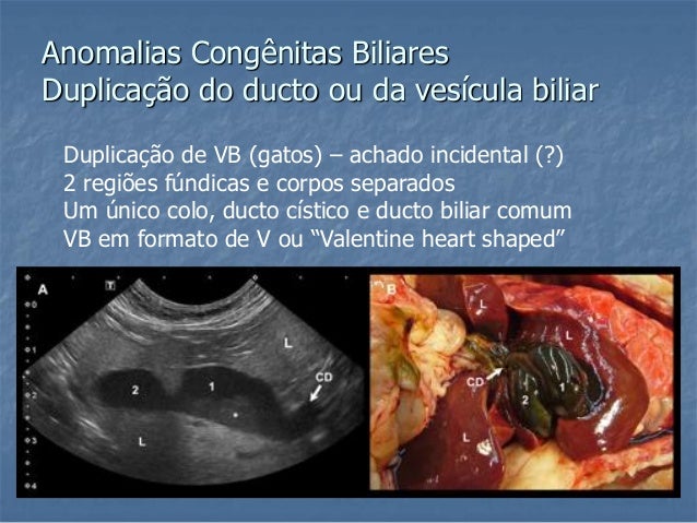 Aula Vesícula Biliar