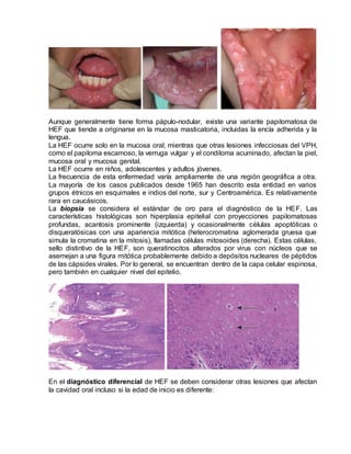 HIPERPLASIA EPITELIAL FOCAL | DOCX