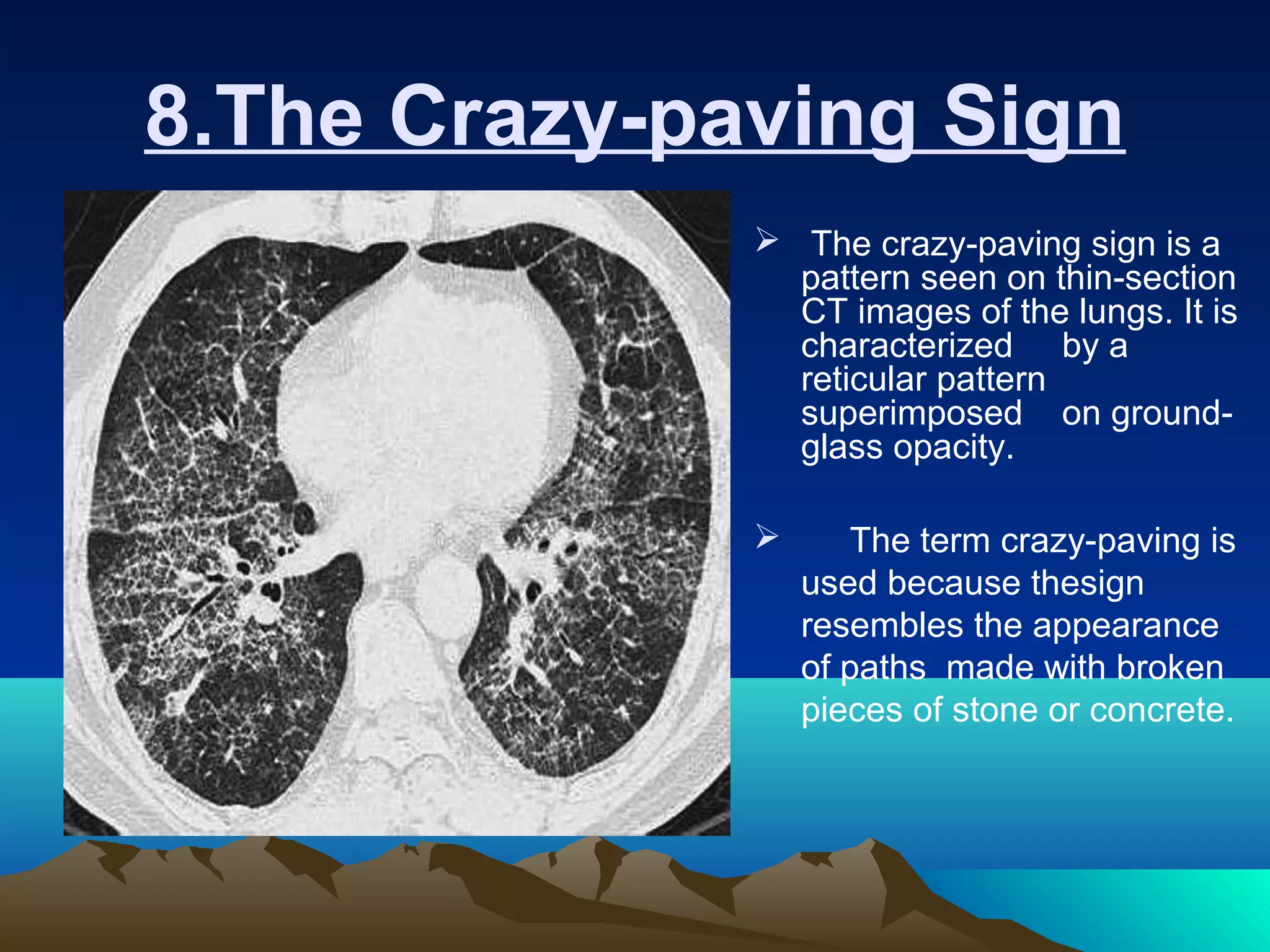 Radiology signs | PPT