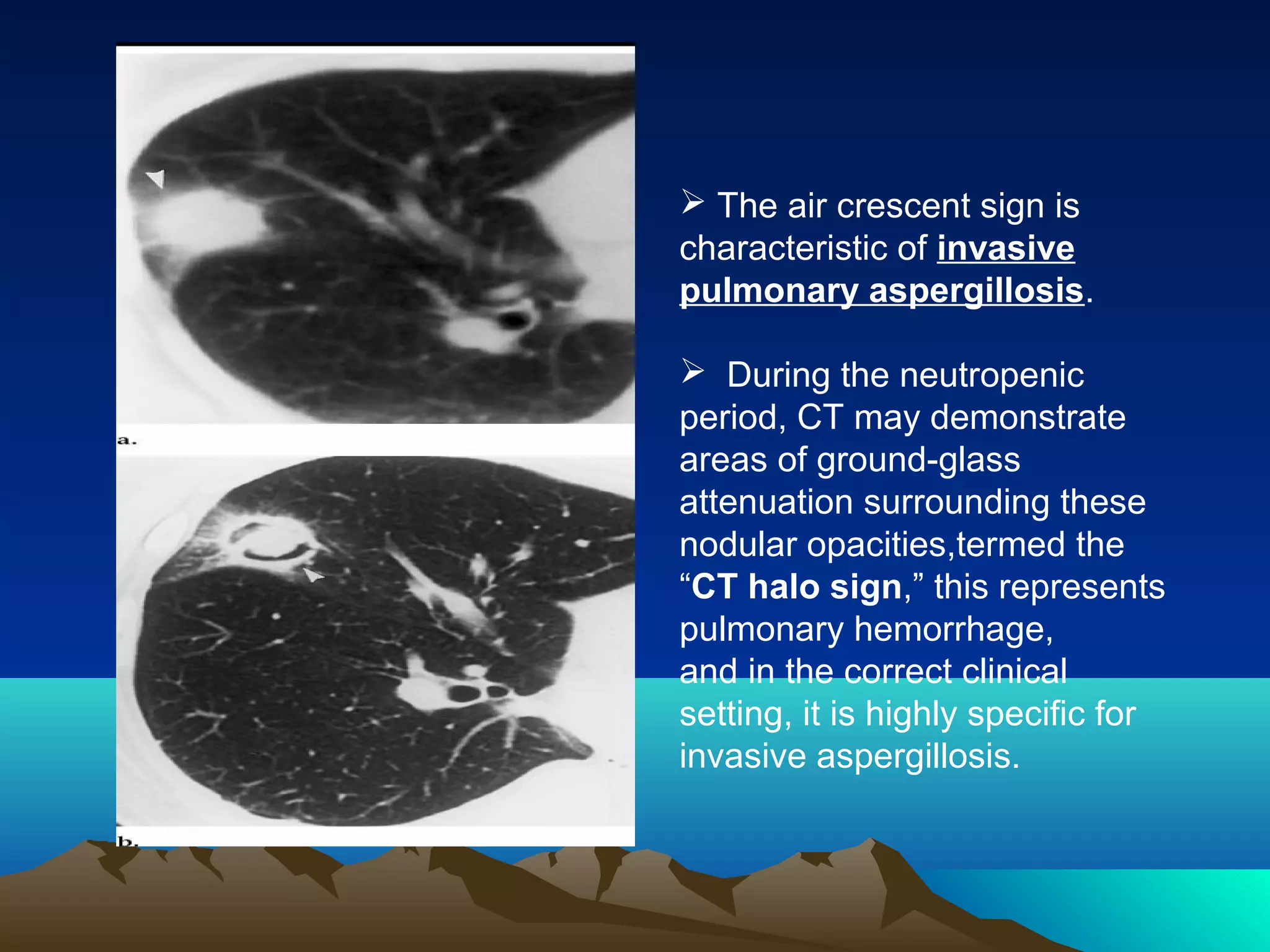Radiology signs | PPT