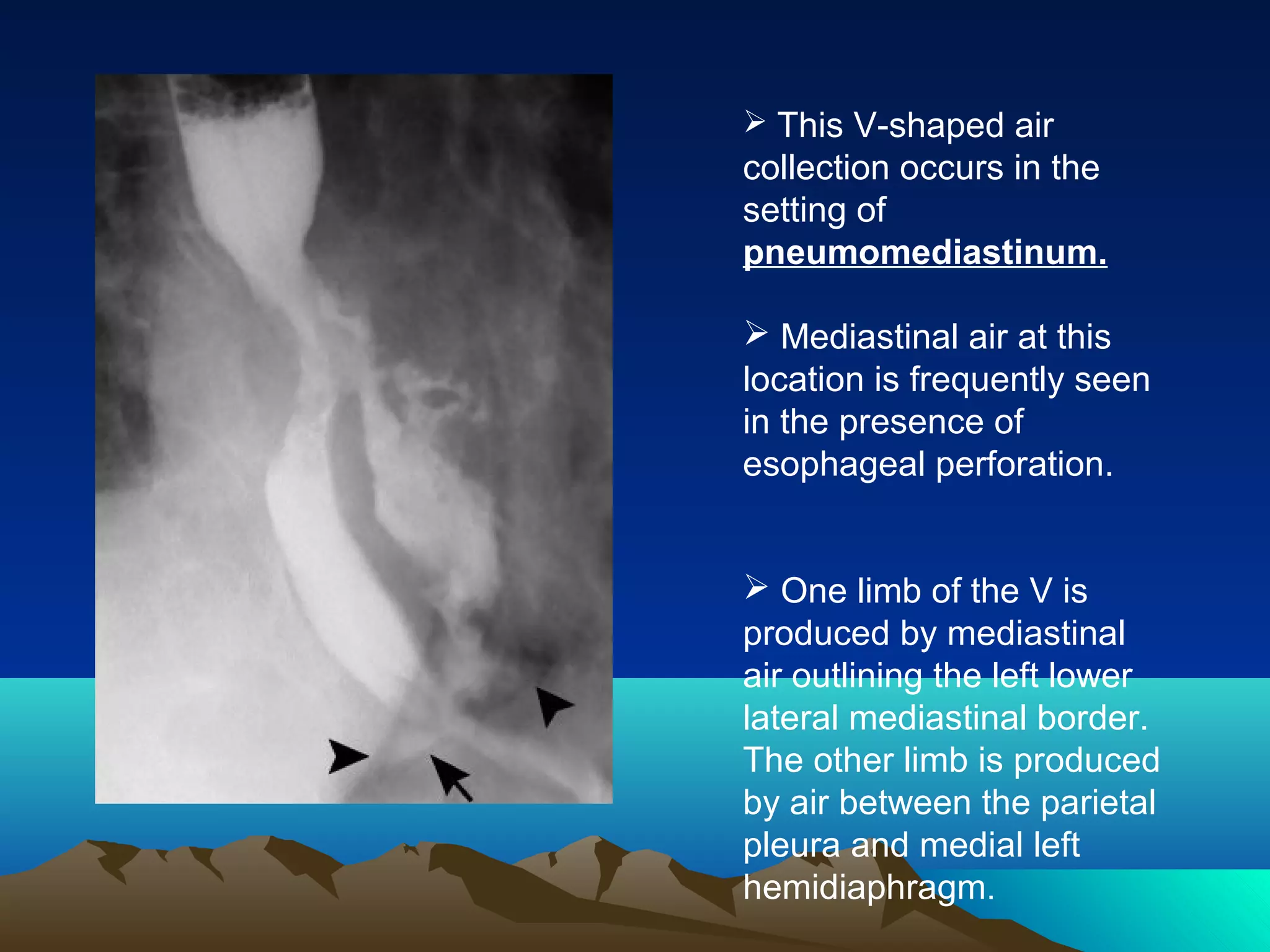 Radiology signs | PPT