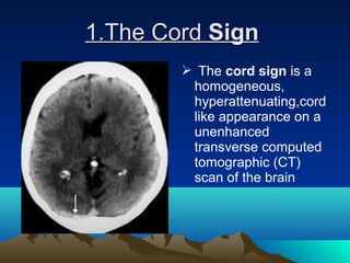 Radiology signs | PPT