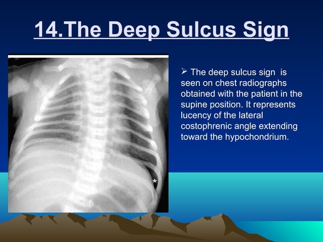 Radiology signs | PPT
