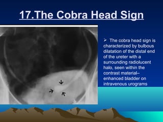 Ureterocele Cobra Head Sign