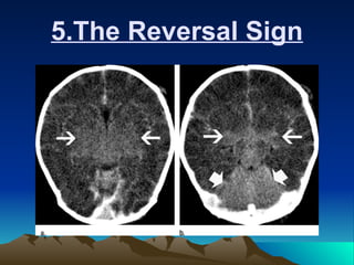 the radiological signs in imaging of gastro Aunt minnie signs.ppt