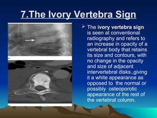 the radiological signs in imaging of gastro Aunt minnie signs.ppt