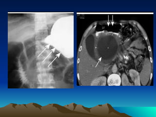 the radiological signs in imaging of gastro Aunt minnie signs.ppt