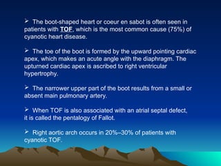 the radiological signs in imaging of gastro Aunt minnie signs.ppt