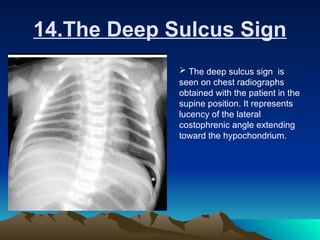 the radiological signs in imaging of gastro Aunt minnie signs.ppt