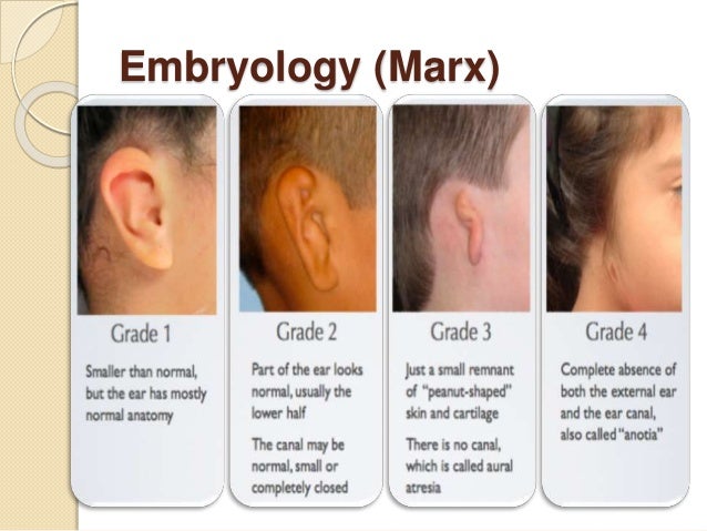 Aural atresia regional conference
