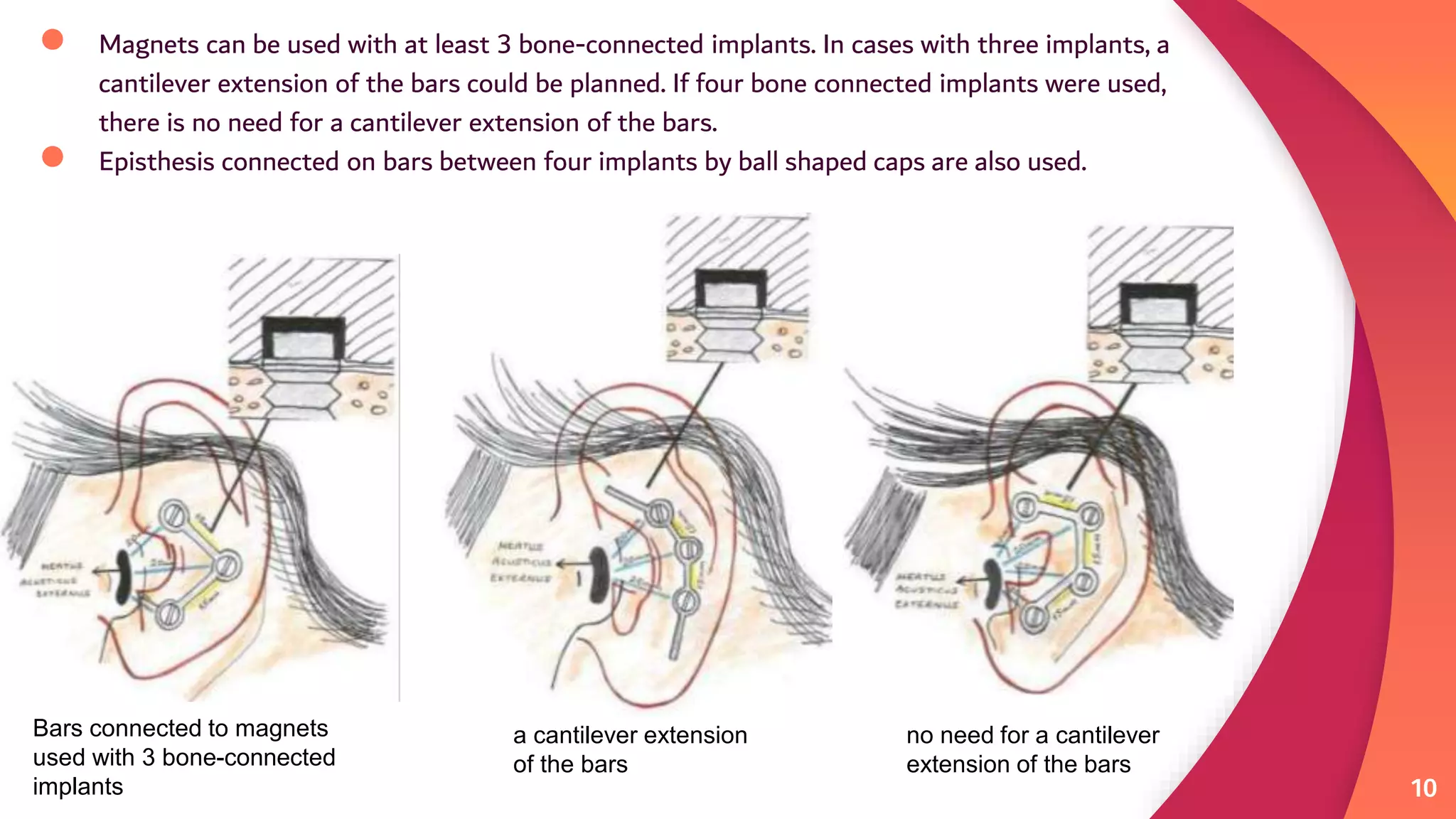 Auricular prosthesis.pptx