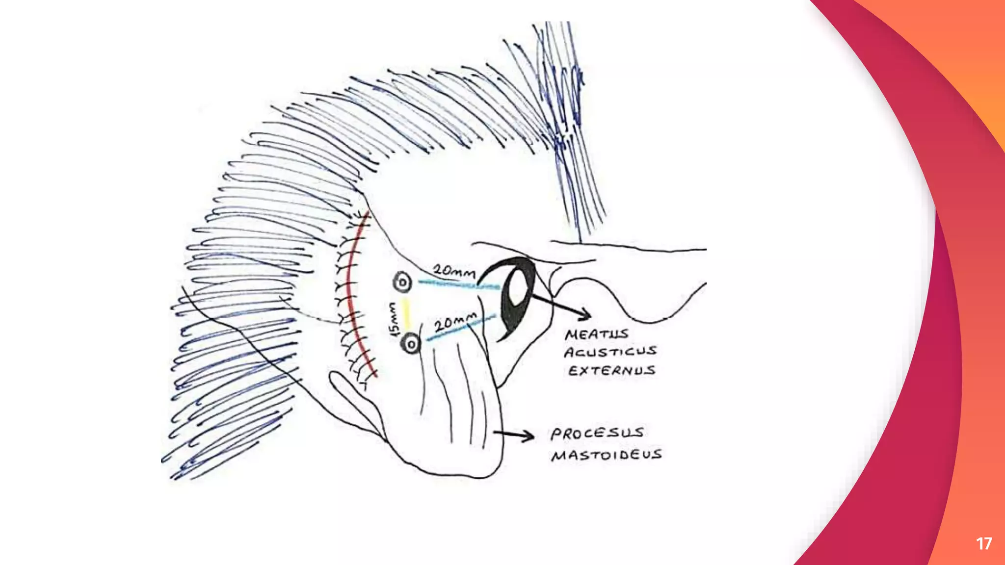 Auricular prosthesis.pptx
