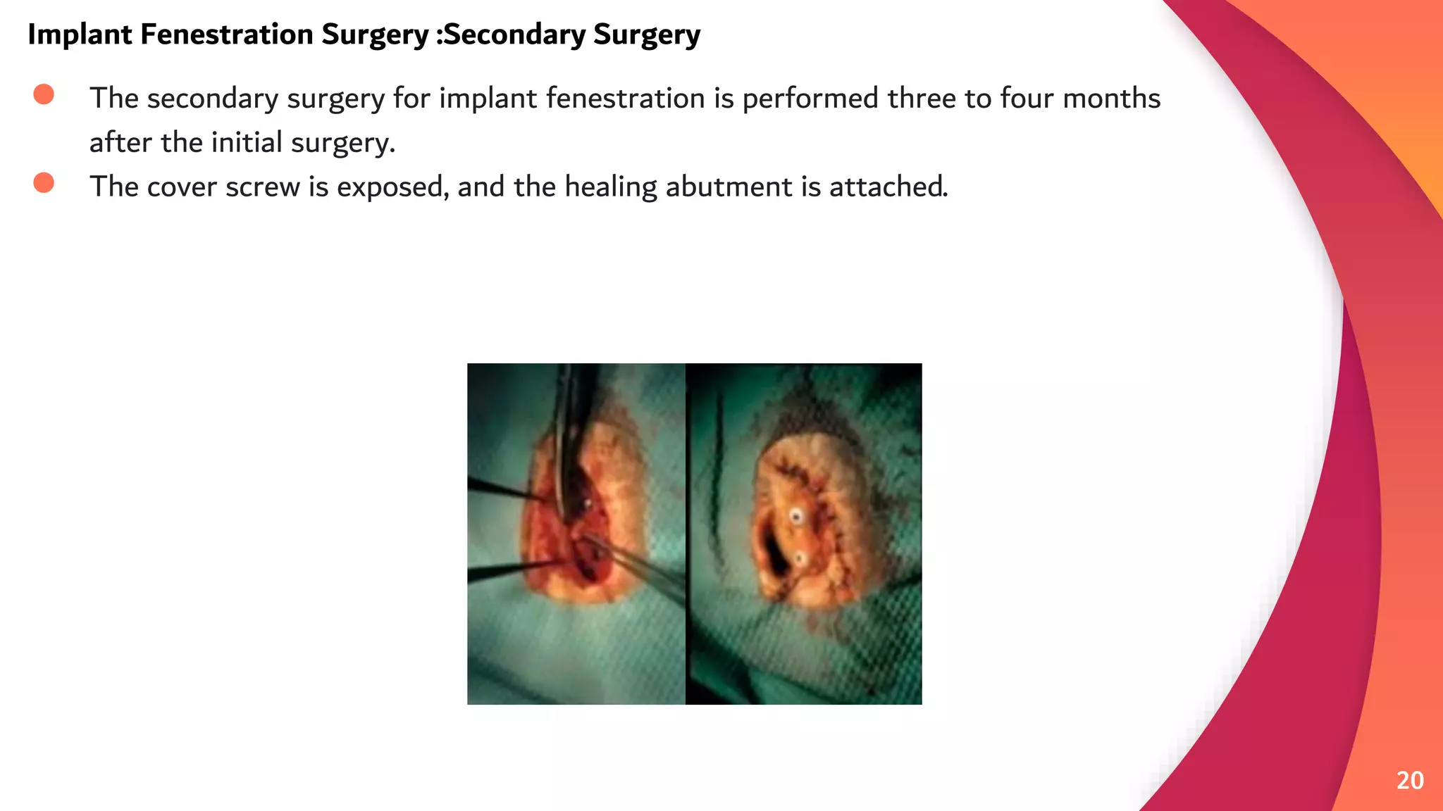 Auricular prosthesis.pptx