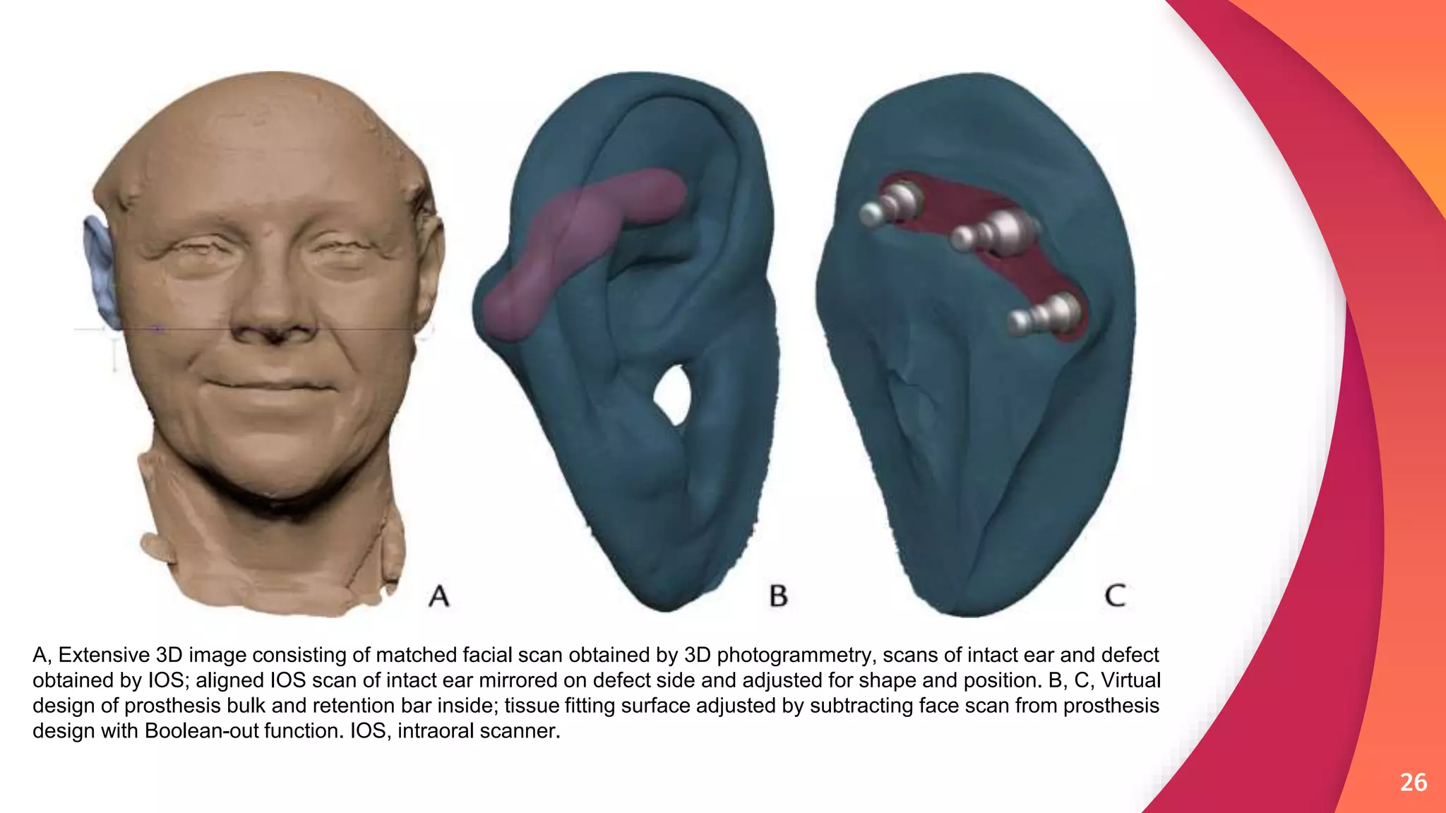 Auricular prosthesis.pptx