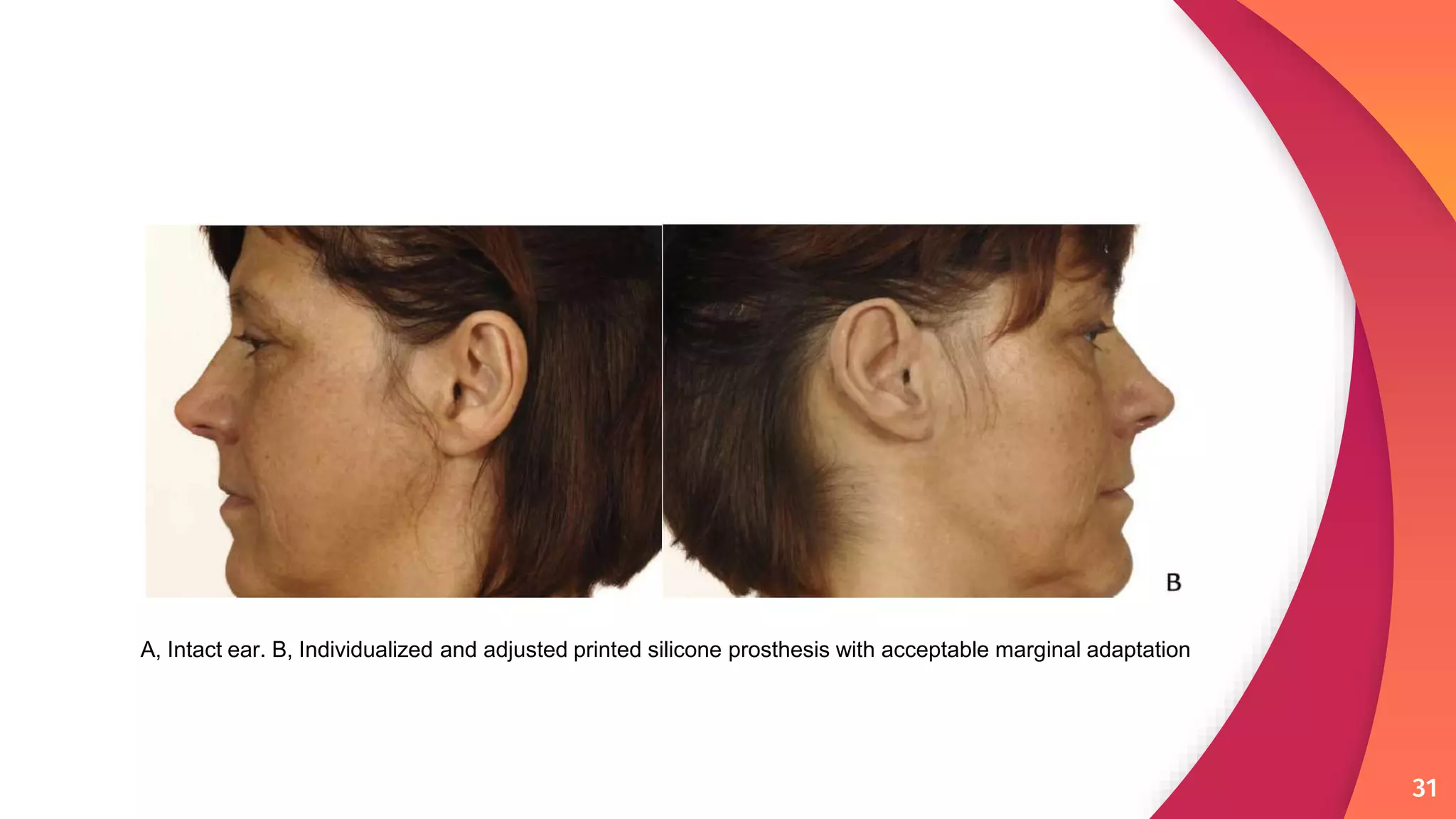 Auricular prosthesis.pptx