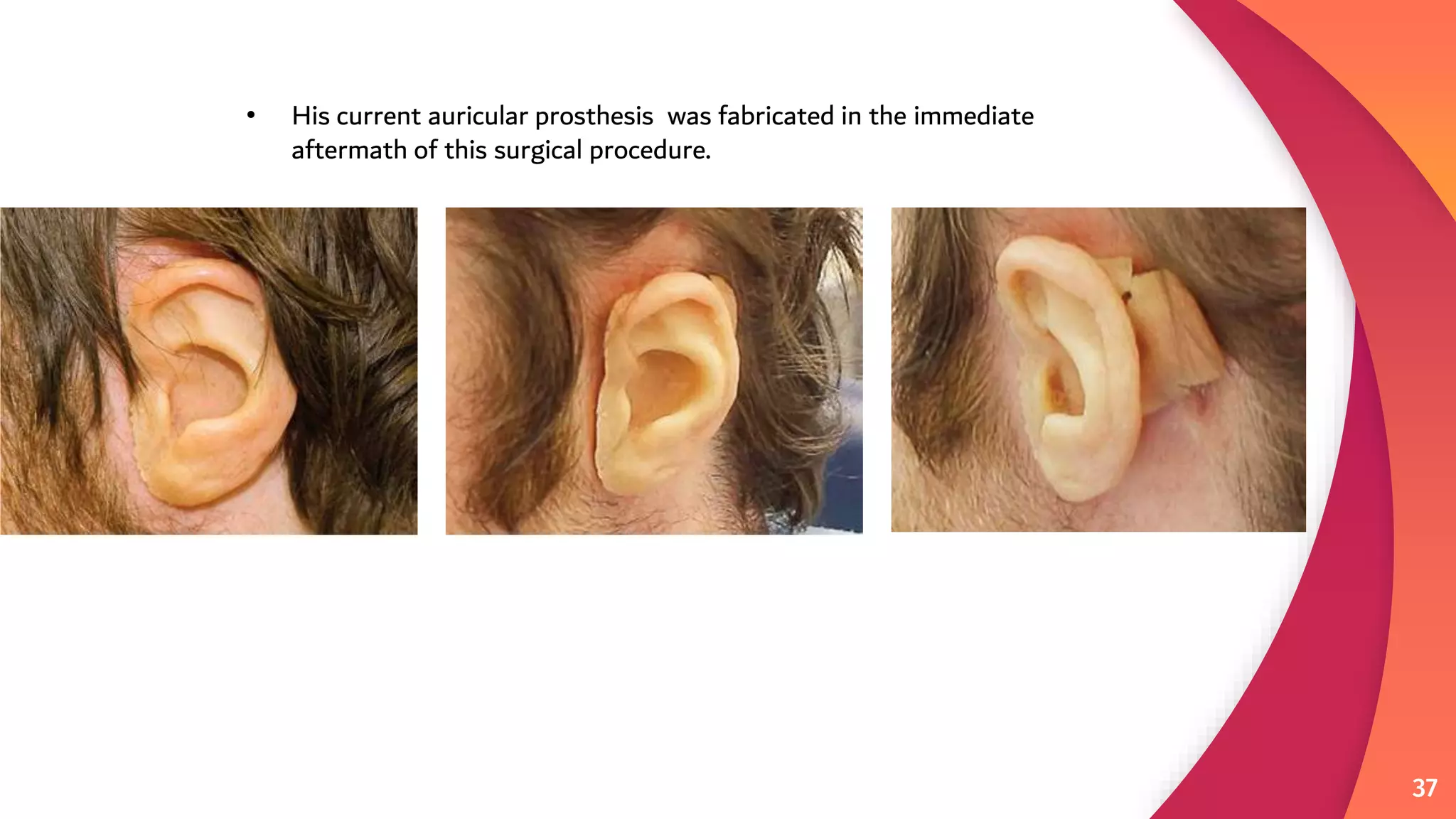 Auricular prosthesis.pptx