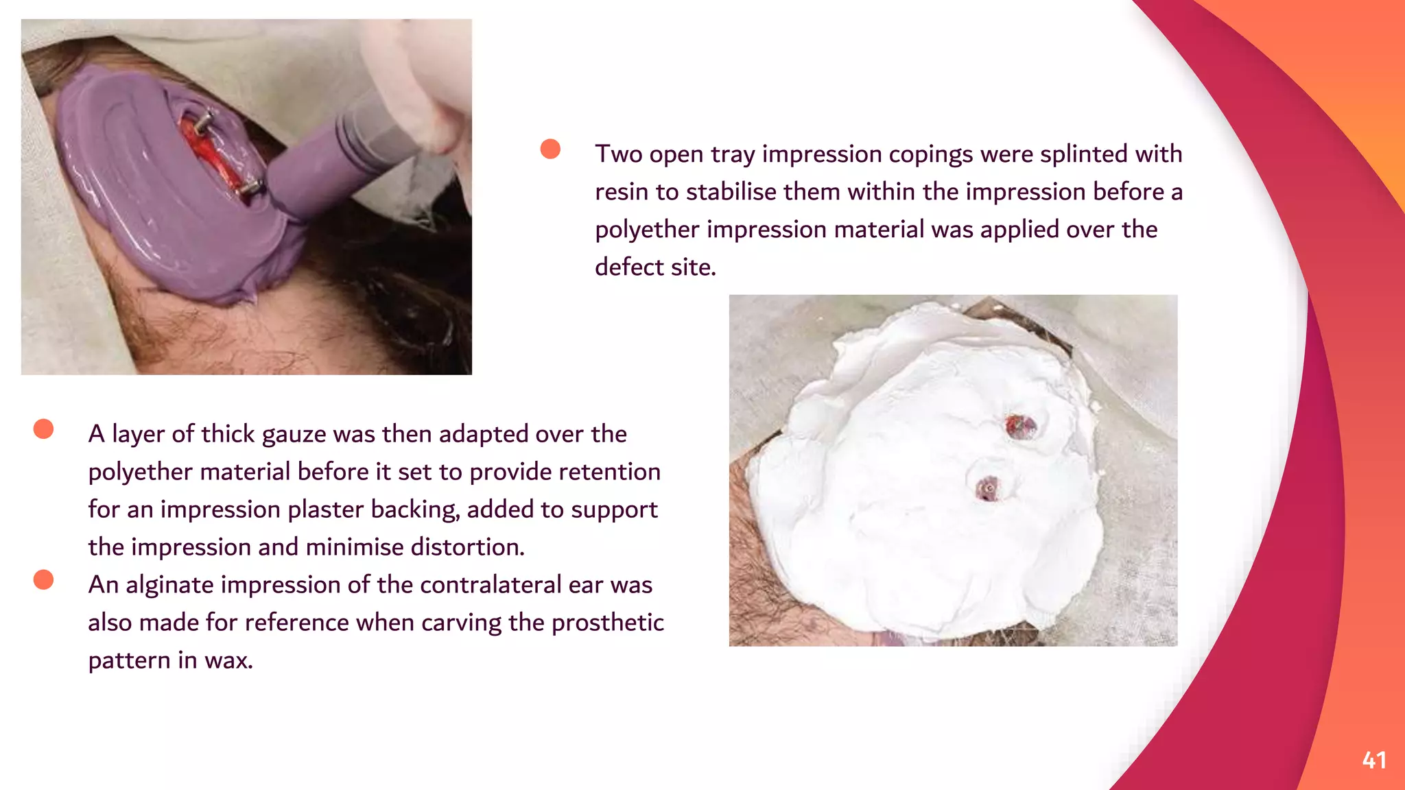 Auricular prosthesis.pptx