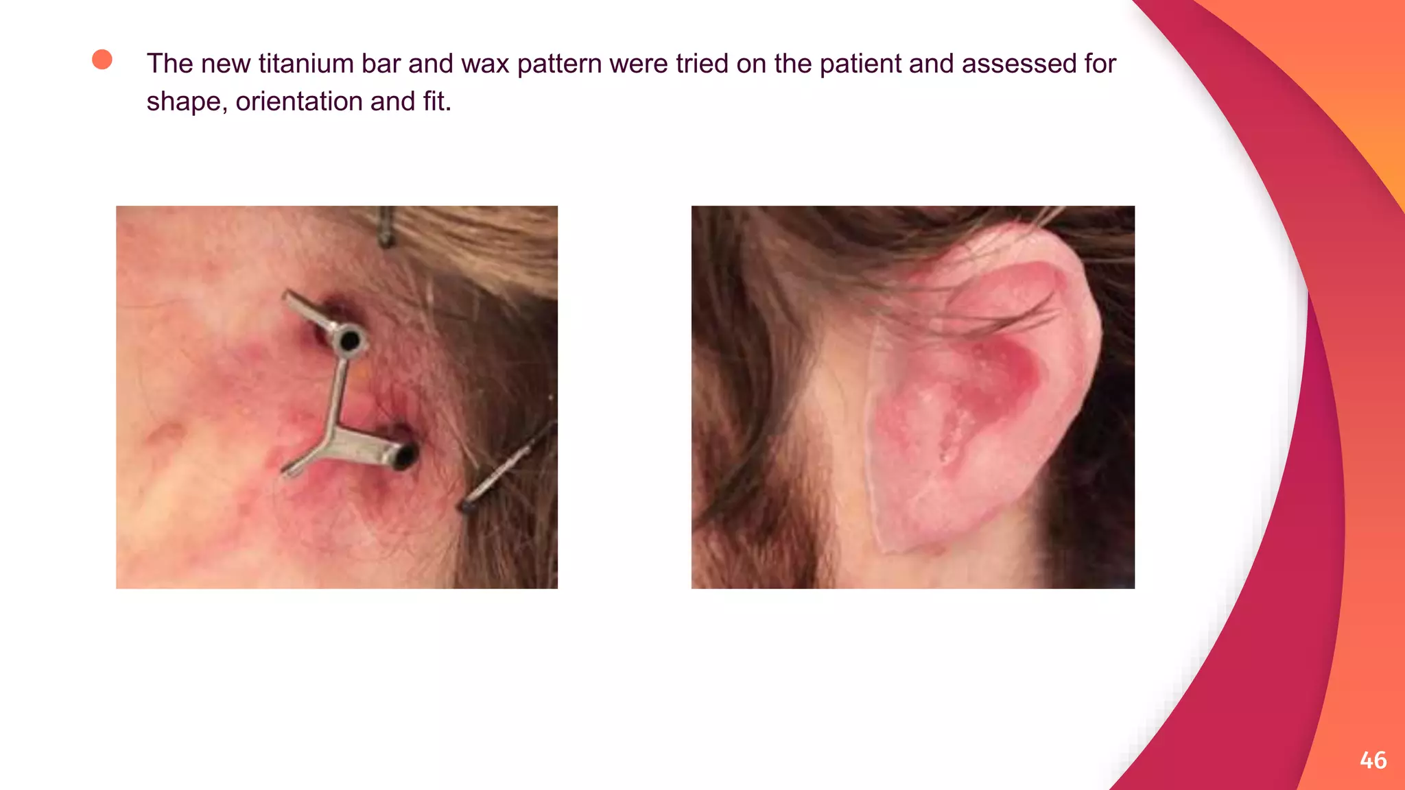 Auricular prosthesis.pptx
