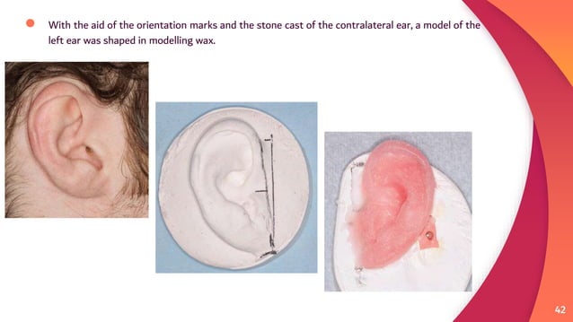 Auricular prosthesis.pptx
