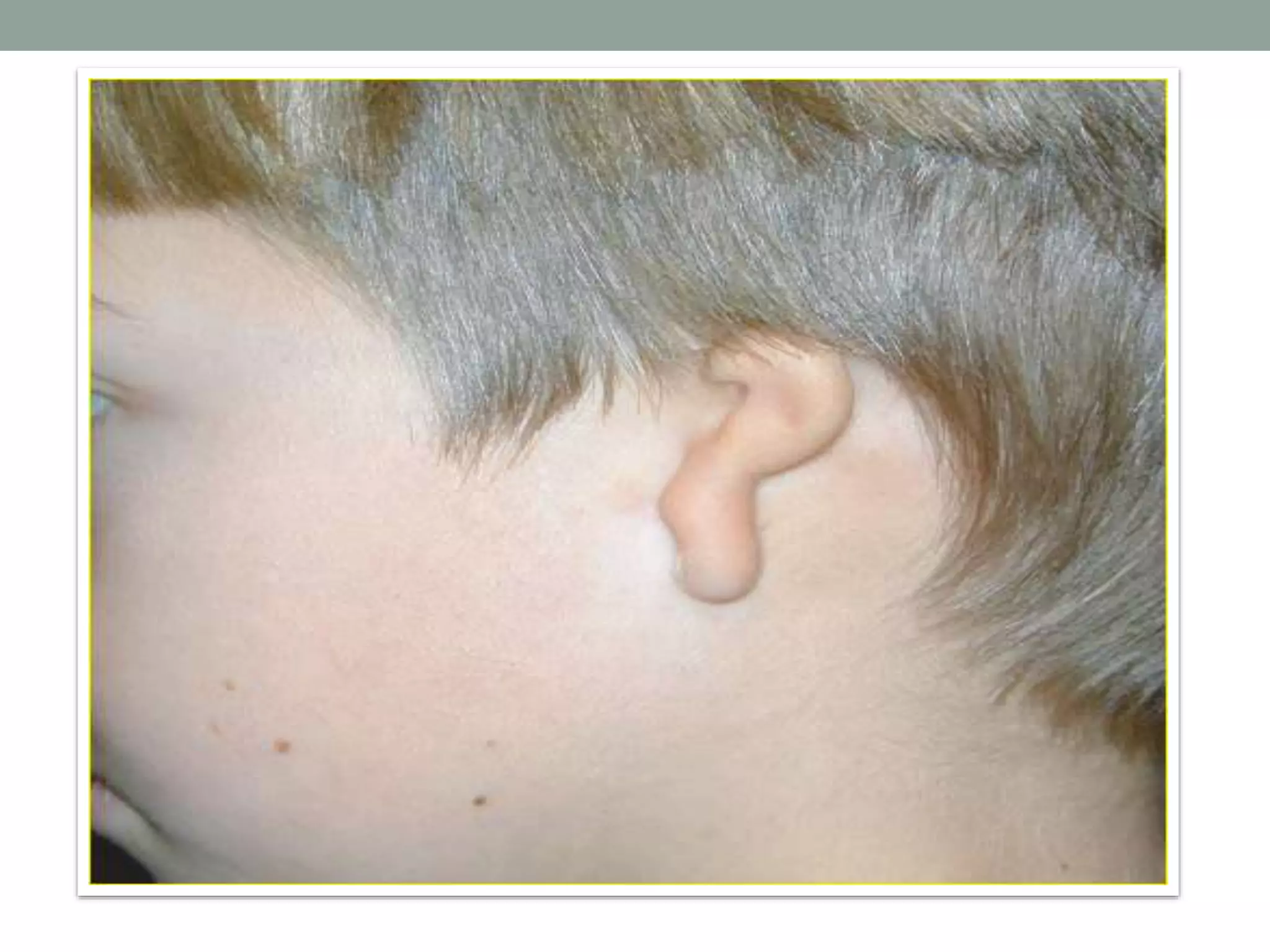 AURICULAR Reconstruction 1.pptx