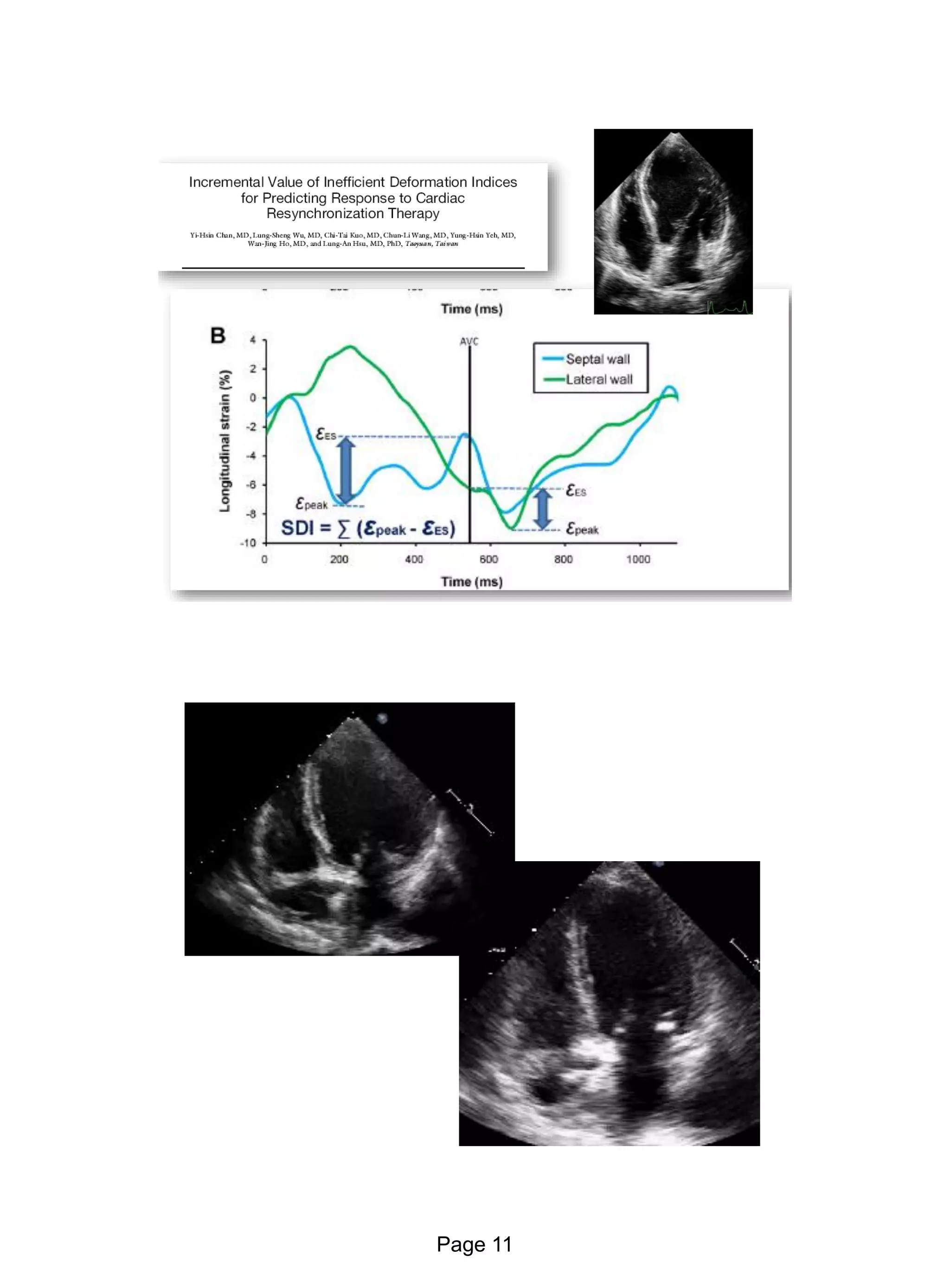 Echo in ischaemic heart disease and Myocardial infarction | PDF