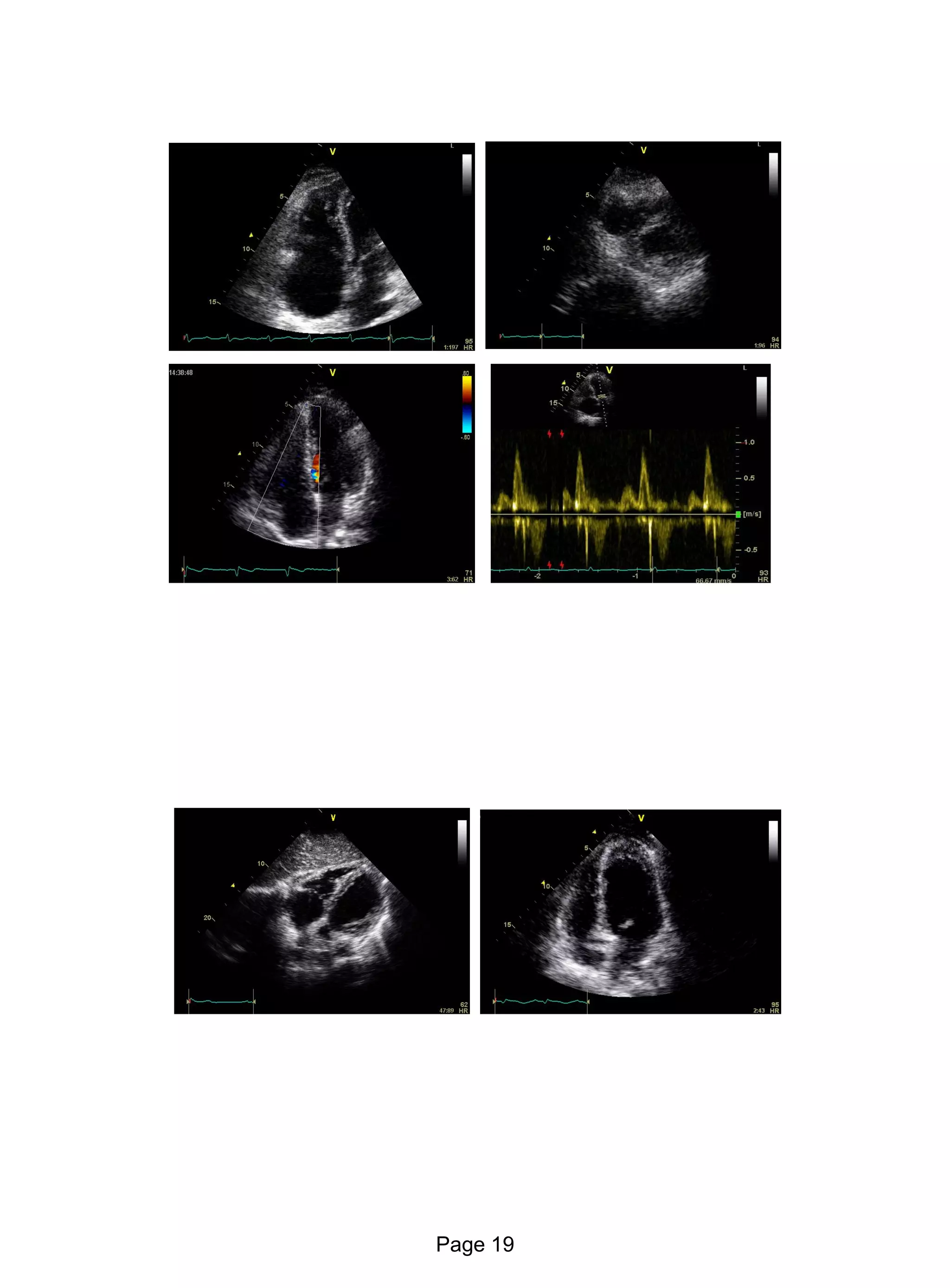 Echo in ischaemic heart disease and Myocardial infarction | PDF