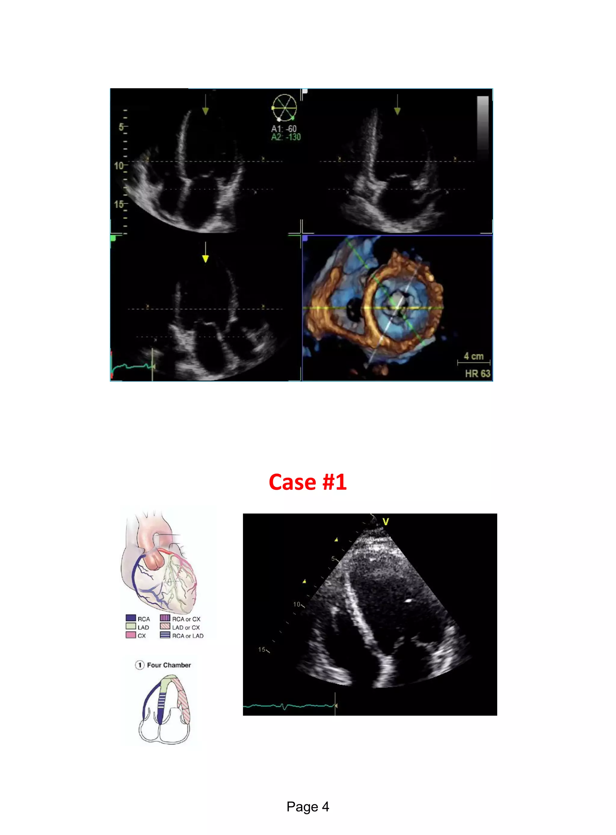 Echo in ischaemic heart disease and Myocardial infarction | PDF